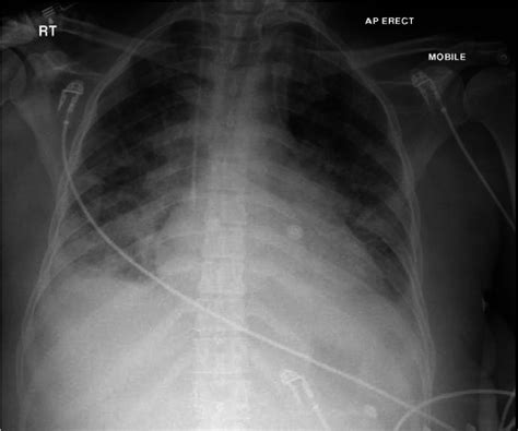 Chest X Ray Showing Bilateral Diffuse Infiltrates Download Scientific Diagram