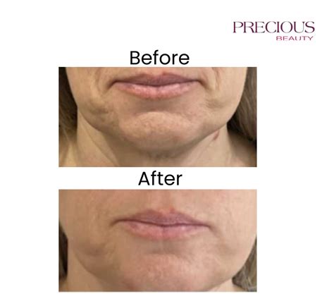 Neck And Chin Hifu Treatment Precious Beauty Mornington Peninsula