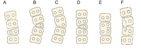 Newborn Spine Deformities Clinical Tree Newborn Spine Deformities Clinical Tree