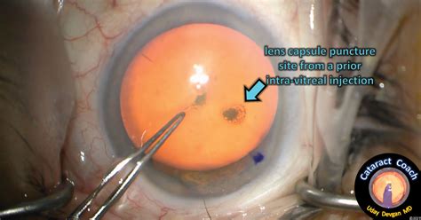 Intravitreal Injection