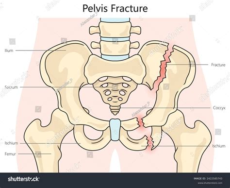 Pelvic Pelvis Fracture Structure Diagram Hand Stock Vector Royalty Free 2422585743 Shutterstock