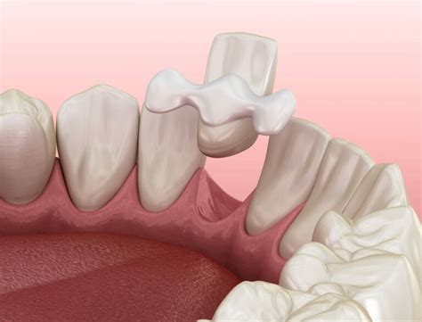 Maryland Bridge A Conservative Solution For Missing Teeth Southern