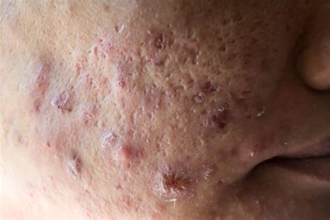 Nodular Acne