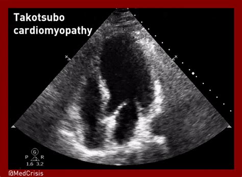 Another Takotsubo 68f Actually Presented After Some Grepmed