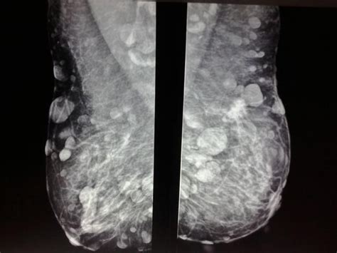 Pin On Excalibur S Breast Imaging Board