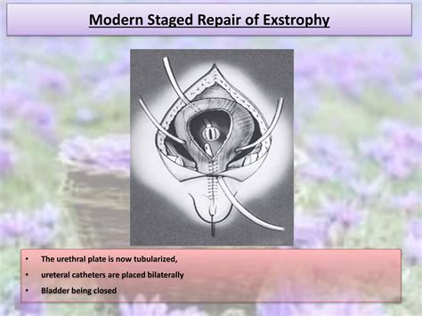 Exstrophy Epispadias Complex Msre And Cpre Pptx