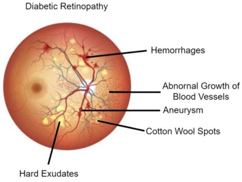 A Survey On Diabetic Retinopathy Lesion Detection And Segmentation