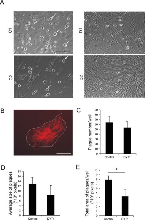 Hsv Replication Dynamics In Dyt1 And Control Fibroblasts Human Patient