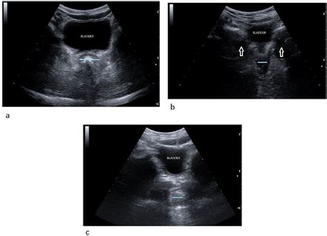 Figure 1 From Measurement Of Rectal Diameter And Anterior Wall