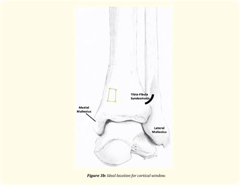 Distal Tibia Anatomy