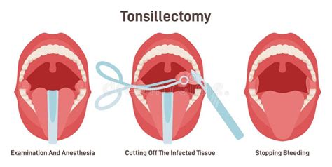 Tonsillectomy Acute Pharyngitis Treatment Surgical Removal Of The Tonsils Stock Vector