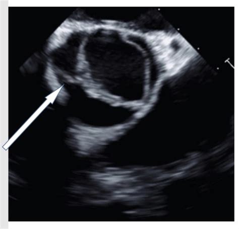 Echo Theory Exam 1 Aoritc Valvular Heart Disease Flashcards Quizlet