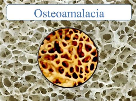 Osteomalacia Pptx Bone And Joint Conditions Diseases And Conditions