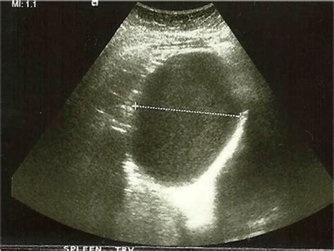 Images From Abdominal Ultrasound Demonstrating The Hepatic Cyst