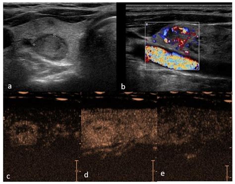 Thyroid Nodule Ultrasound