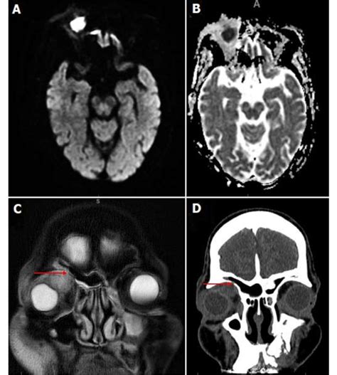 A Axial Diffusion Weighted Imaging Mri Of The Orbits Without Contrast Download Scientific