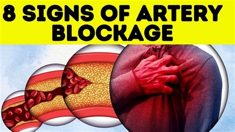 8 Warning Signs Of Artery Blockages You Should Never Ignore Signs Of
