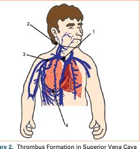 Anesthetic Implications Of Superior Vena Cava Syndrome In