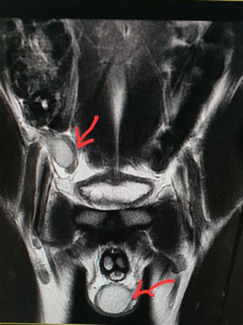 Imen Ganzoui On Linkedin Ectopic Right Testicle In An Adult Mri T2 Wi