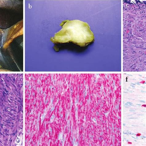 A Laparoscopic View Of The Gallbladder Showing The Tumour Bulging