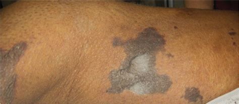 Hyperphosphatemia Skin