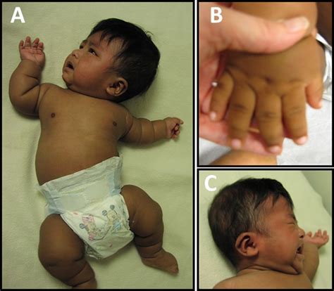Hypochondroplasia Dwarfism