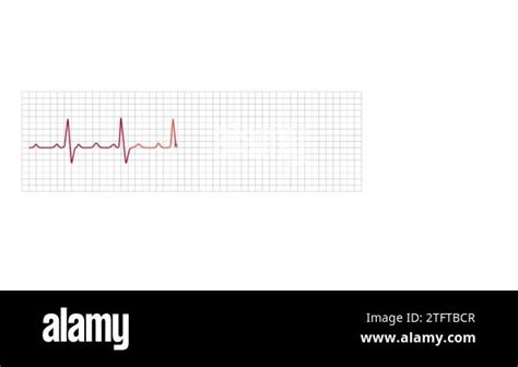 Animated Electrocardiograph Monitor Graph That Shows Second Degree