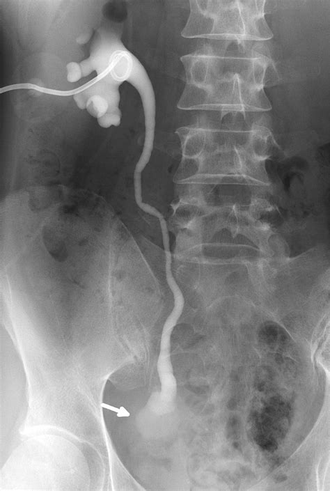 Transrenal Ureter Embolization For Refractory Urine Leaks From