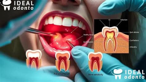 Queilite Angular Como Tratar E Prevenir Planos Odontológicos Blog