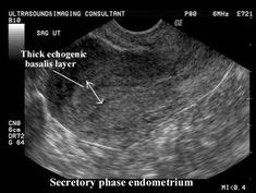 Free Fluid In Posterior Cul De Sac OB Gyn Ultrasound Mod Ultrasound Vascular