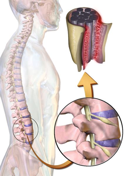 Arachnoiditis Physiopedia