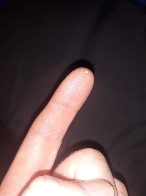 Is There A Cure For Tonsil Stones The Truth Tonsil Tamer
