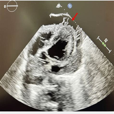 Electrocardiogram On Initial Presentation The Image Shows Diffuse St