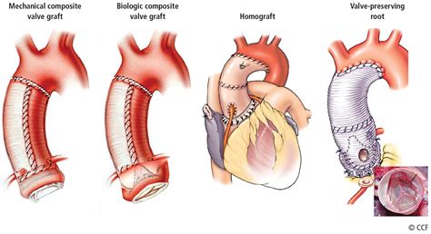 Aortic Replacement In Cardiac Surgery Mdedge