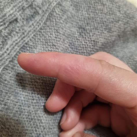 Red Bumps On Fingers Sometimes On Other Joints Too That Get Redder
