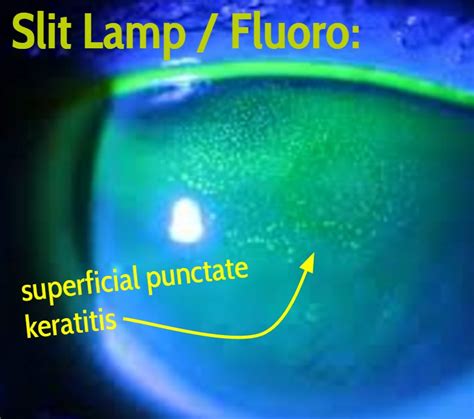 Superficial Punctate Keratitis