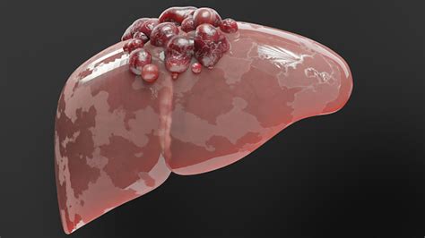 소화기 간암 간염 간경변 악성 종양 간부전 성장 세포 복제 섬유증 간경변 간세포 암종 바이러스 감염 간 인간 3d 렌더링 간 내부 기관에 대한 스톡 사진 및 기타 이미지