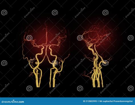 Cta Brain Or Ct Angiography Of The Brain 3d Rendering Image Ap And Lateral View Showing Cerebral
