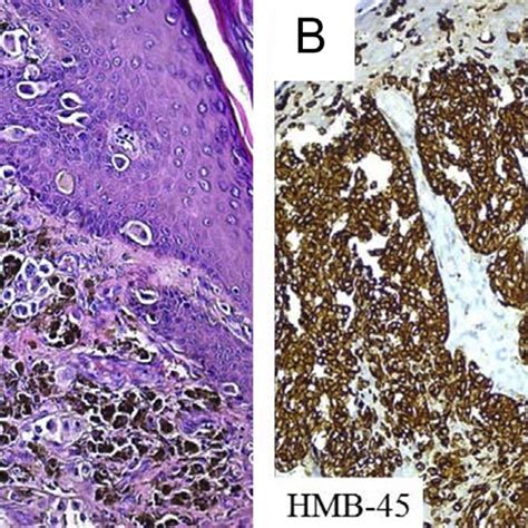 Histopathological Appearance Of Cutaneous Malignant Melanoma In A