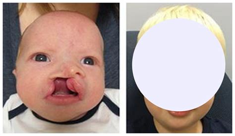 La Transformation Du Visage De Ce Bébé Est Incroyable Il A Grandi Et Est Devenu Un Beau Garçon