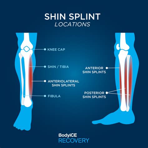 Shin Splints Too Much Treadmill Outdoor Training Could Help Your Shin