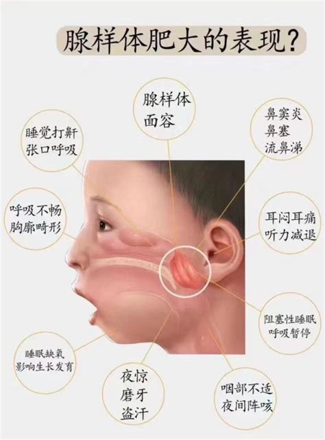 「科普」认识 小呼噜”的背后——儿童腺样体肥大的诊断与危害 健康科普 漯河市中心医院
