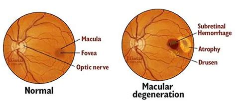 Age Related Macular Degeneration Optometry Located In Brooklyn Ny