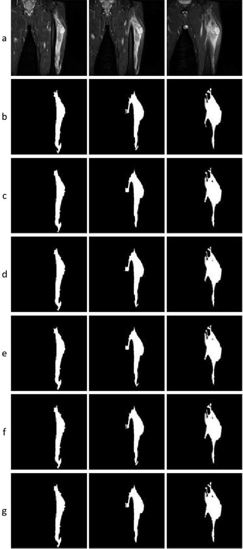 optimized otsu segmentation results of leg images a normal leg image