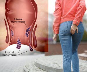 How Internal Hemorrhoids Are Diagnosed