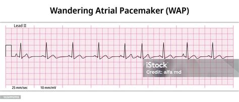 Ekg Wandering Atrial Pacemaker Kertas Ekg 8 Detik Ilustrasi Stok