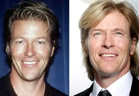 Jack Wagner Plastic Surgery Rinterstimnews