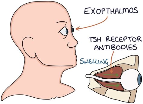 Hyperthyroidism Zero To Finals