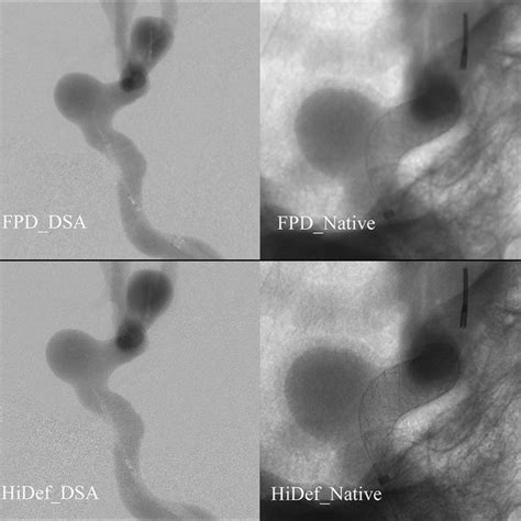 Sample Single Image Sequence Pair Acquired Under DSA Exposures The Download Scientific Diagram