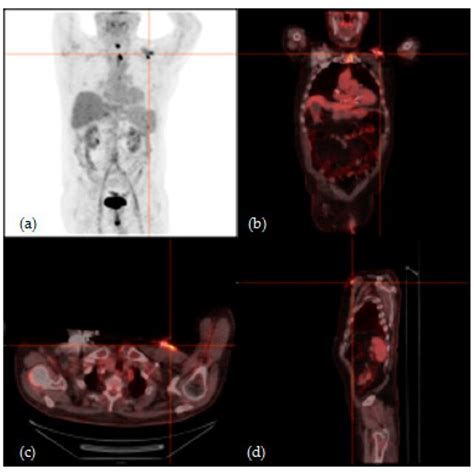¹⁸f Fluorodeoxyglucose Positron Emission Tomography Computed Tomography Download Scientific
